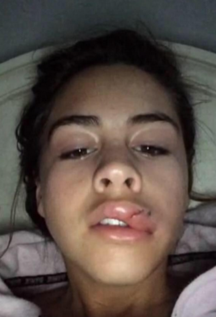 Kylie Jenner Challenge When Good Lips Go Bad